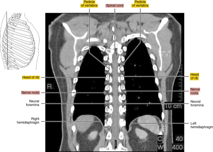 CT of the male pelvis | Radiology Key