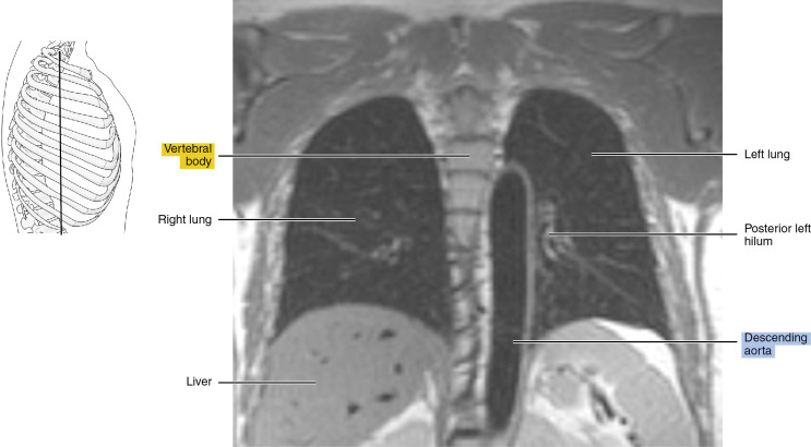 MRI of the heart | Radiology Key