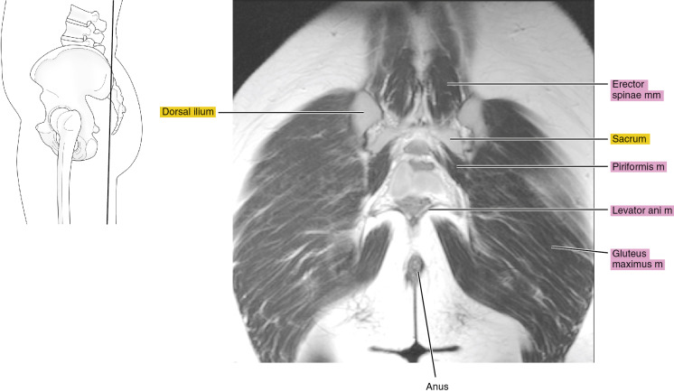 MRI of the female pelvis | Radiology Key