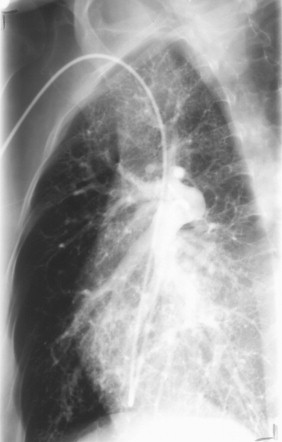 Pulmonary Manifestations of Gastrointestinal Diseases | Radiology Key