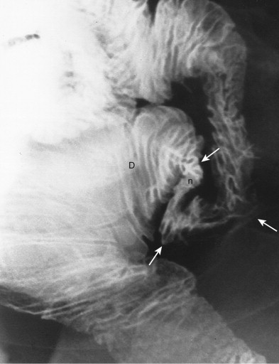 Pictorial Glossary of Double-Contrast Radiology | Radiology Key