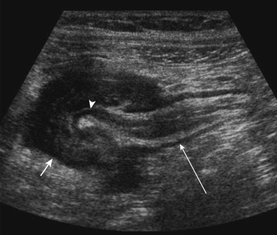 Ultrasound of the Hollow Viscera | Radiology Key