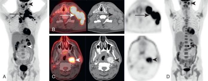 Head and Neck on FDG PET/CT | Radiology Key