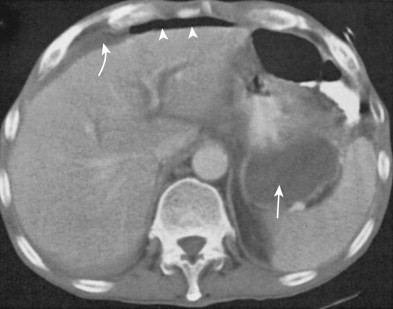Angiography and Interventional Radiology of the Hollow Viscera ...