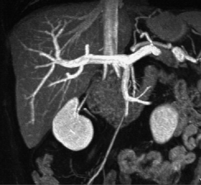Magnetic Resonance Angiography of the Mesenteric Vasculature ...