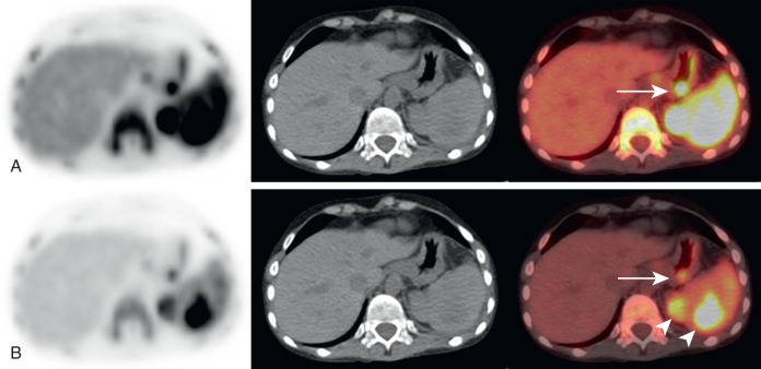 Spleen on FDG PET/CT | Radiology Key