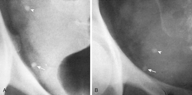 Abdominal Calcifications | Radiology Key