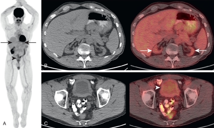 Urinary Tract on FDG PET/CT (Kidneys, Ureters, Bladder) | Radiology Key