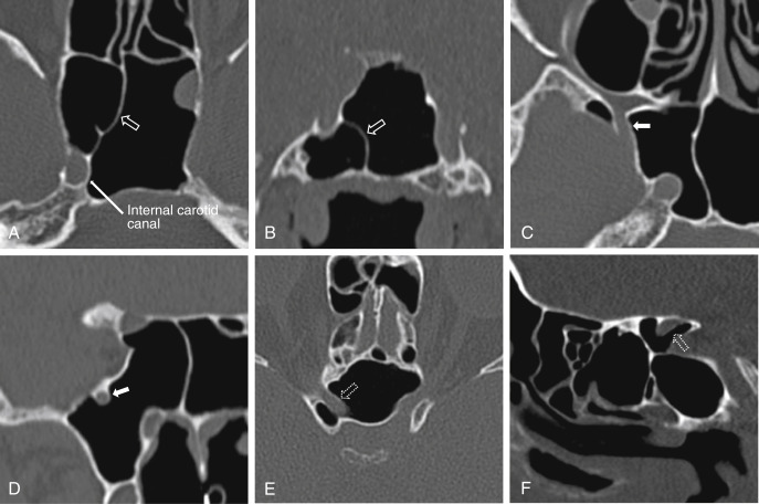 Imaging of the Paranasal Sinuses and Their Surgical Relevance ...