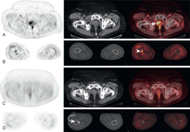 FDG PET/CT Performance and Reporting | Radiology Key