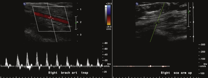 Upper Extremity Arterial Disease | Radiology Key