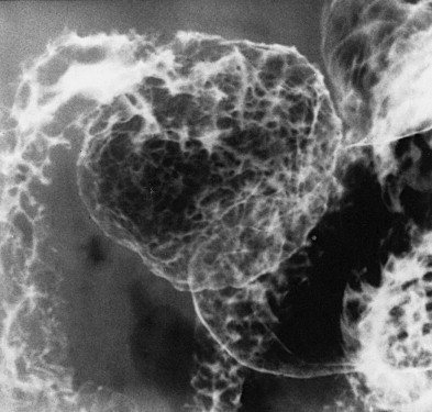 Inflammatory Conditions of the Stomach and Duodenum | Radiology Key