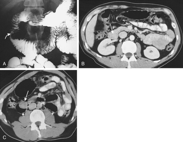 Carcinoma of the Stomach and Duodenum | Radiology Key