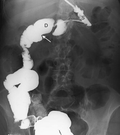 Postoperative Stomach and Duodenum | Radiology Key