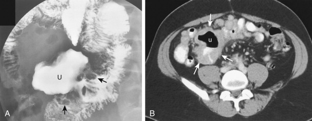 Barium Examinations of the Small Intestine | Radiology Key