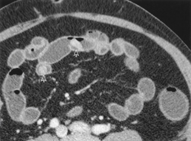 Benign Tumors of the Small Bowel | Radiology Key