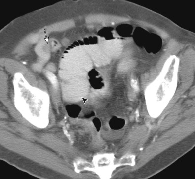 Acquired Lesions Of The Small Intestines Radiology Key