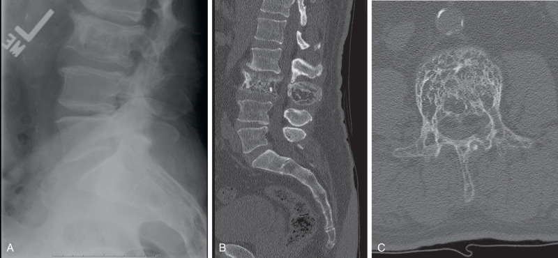 Paget Disease Pelvis Image Radiopaediaorg