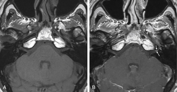 Temporal Bone Inflammatory and Infectious Diseases | Radiology Key