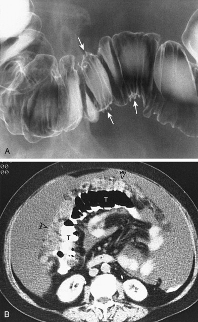 Other Tumors of the Colon | Radiology Key