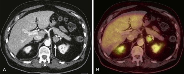 Positron Emission Tomography/Computed Tomography of the Solid ...