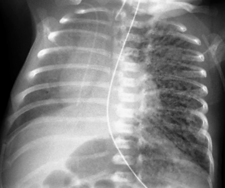 Shift of the Mediastinum | Radiology Key
