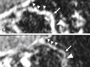 Temporal Bone Trauma | Radiology Key