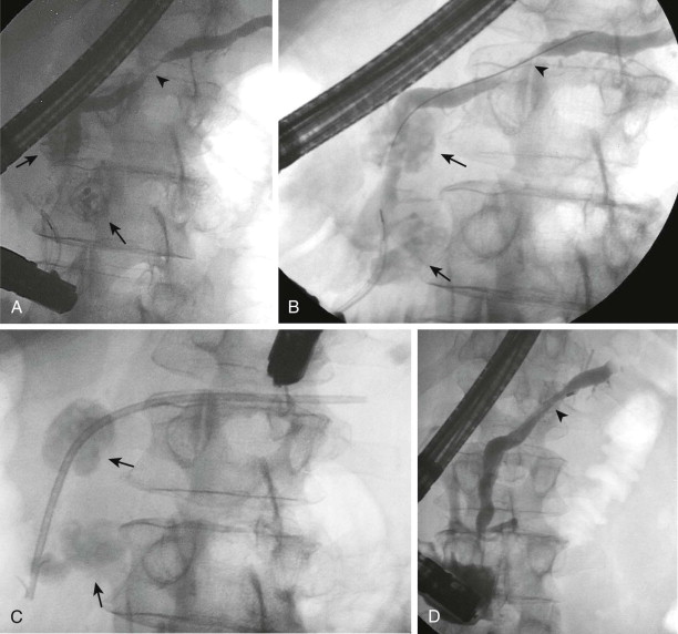 Endoscopic Retrograde Cholangiopancreatography | Radiology Key