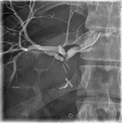 Interventional Radiology of the Gallbladder and Biliary Tract ...