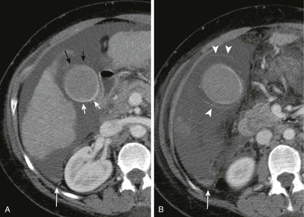 Postsurgical and Traumatic Lesions of the Biliary Tract | Radiology Key