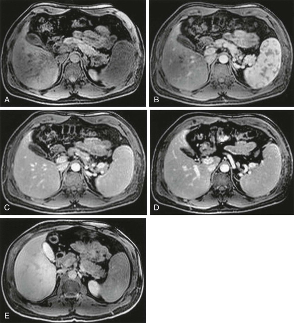 Liver: Normal Anatomy and Examination Techniques | Radiology Key