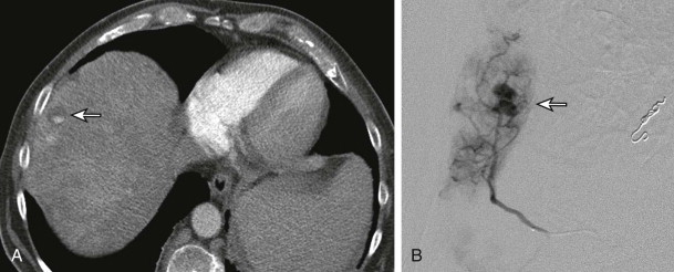 Hepatic Trauma, Surgery, and Liver-Directed Therapy | Radiology Key