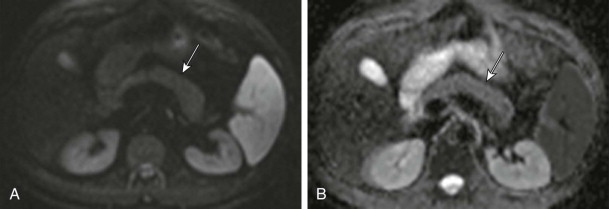 Pancreas: Normal Anatomy and Examination Techniques | Radiology Key