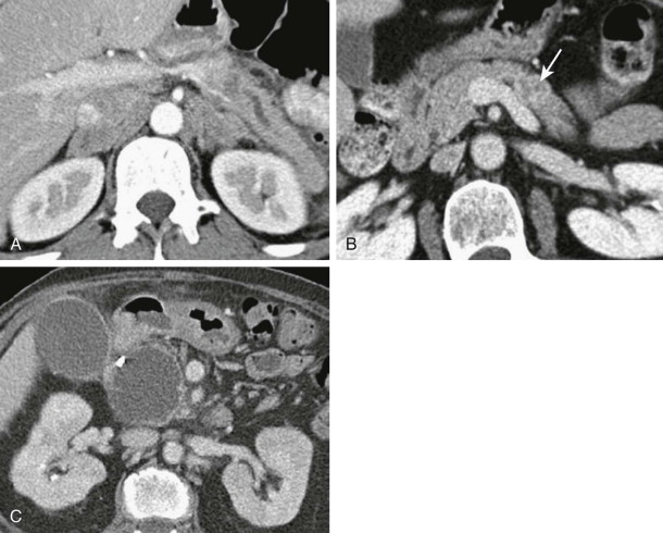 Pancreatic Neoplasms | Radiology Key