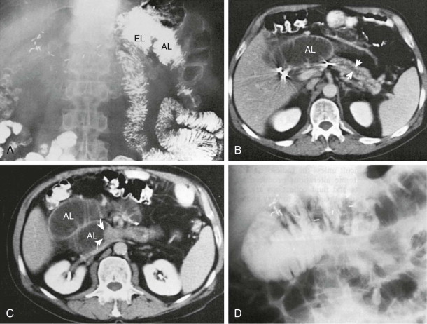 Pancreatic Trauma and Surgery | Radiology Key