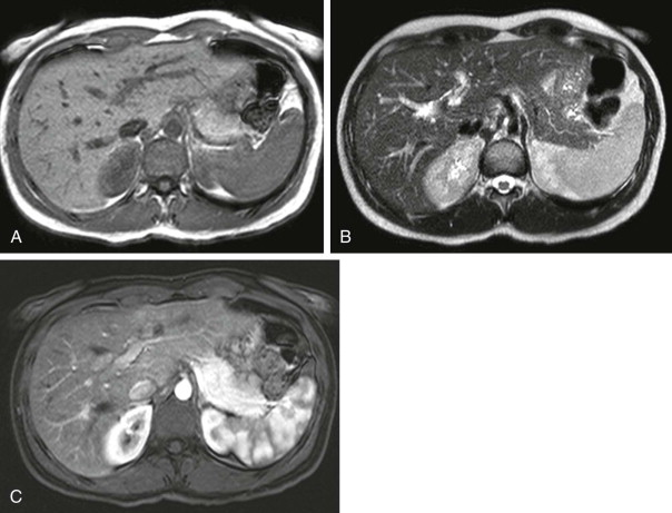 Spleen: Normal Anatomy and Examination Techniques | Radiology Key