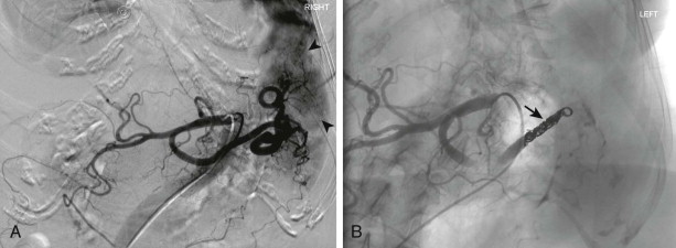 Angiography and Interventional Radiology of the Spleen | Radiology Key