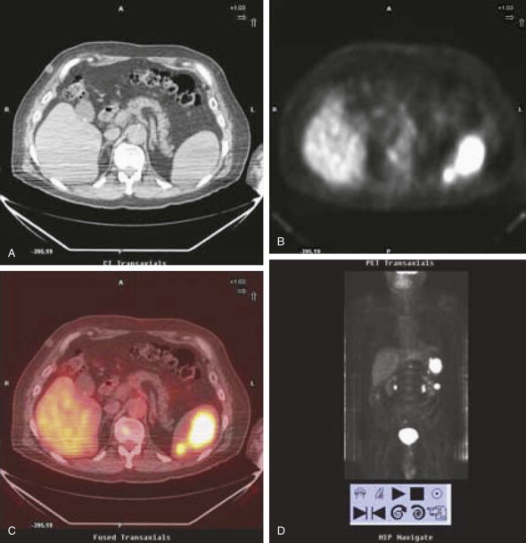 Benign and Malignant Lesions of the Spleen | Radiology Key