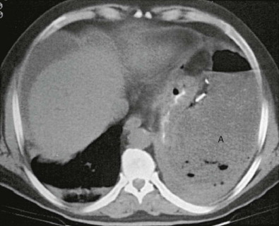 Splenic Trauma and Surgery | Radiology Key