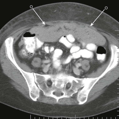 Mesenteric and Omental Lesions | Radiology Key