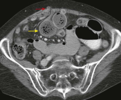 Hernias and Abdominal Wall Pathology | Radiology Key