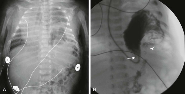 Diseases of the Pediatric Stomach and Duodenum | Radiology Key