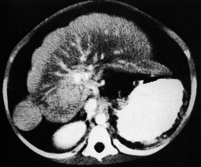 Diseases of the Pediatric Liver | Radiology Key