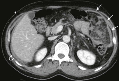 Abdominal Trauma | Radiology Key