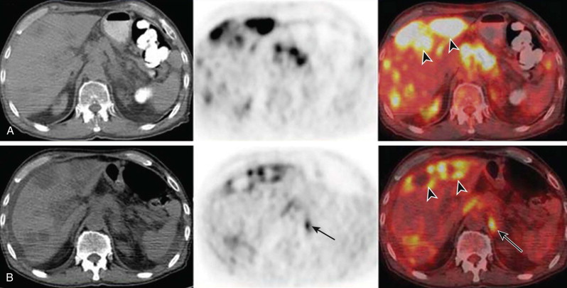 Monitoring Gastrointestinal Tumor Response to Therapy | Radiology Key