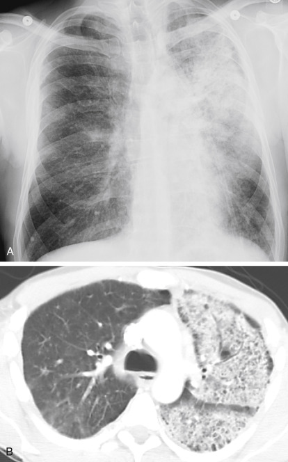 Segmental and Lobar Consolidations | Radiology Key