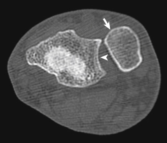 Upper Extremity | Radiology Key