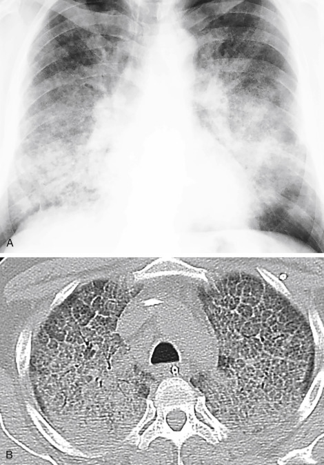 Diffuse Air Space Opacities | Radiology Key