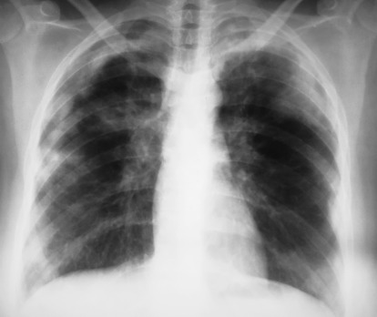 Multifocal Ill-Defined Opacities | Radiology Key