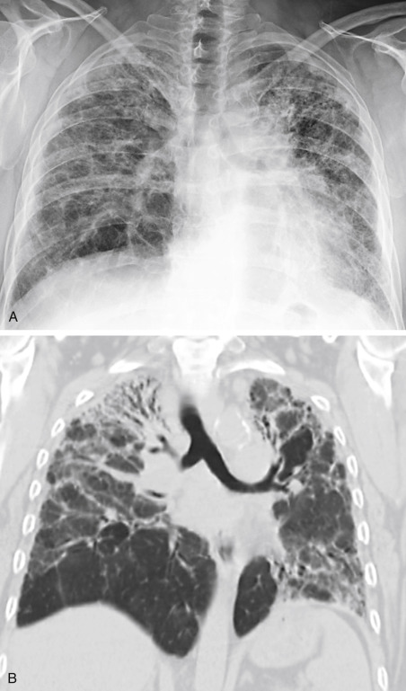 Coarse Reticular Opacities (Honeycomb Lung) | Radiology Key